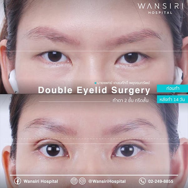 Upper Eyelid Surgery - wansirihospital
