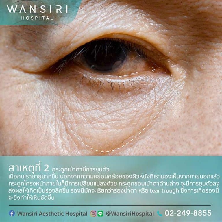 What causes under-eye - Wansiri Hospital