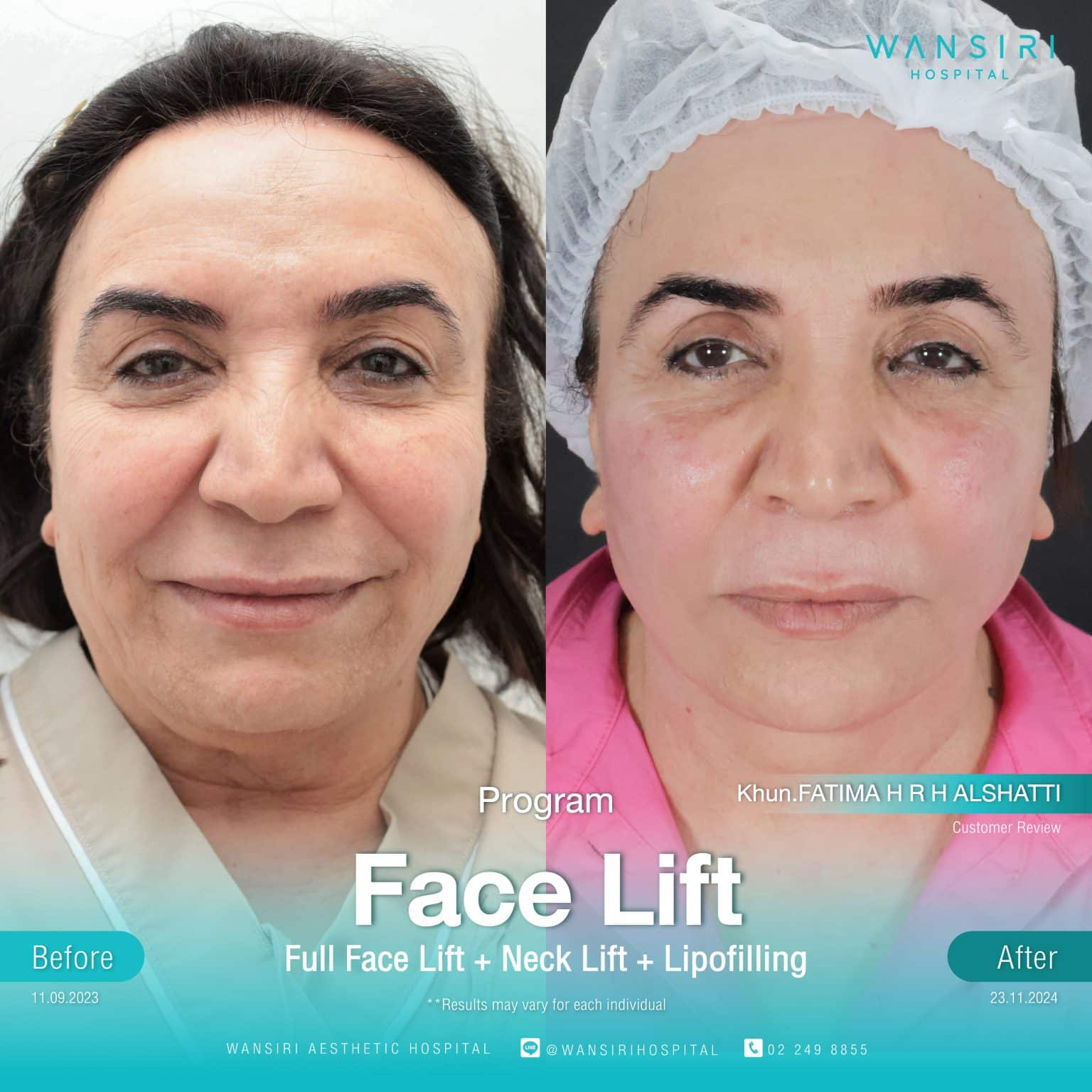 Face Lift - Wansiri Hospital