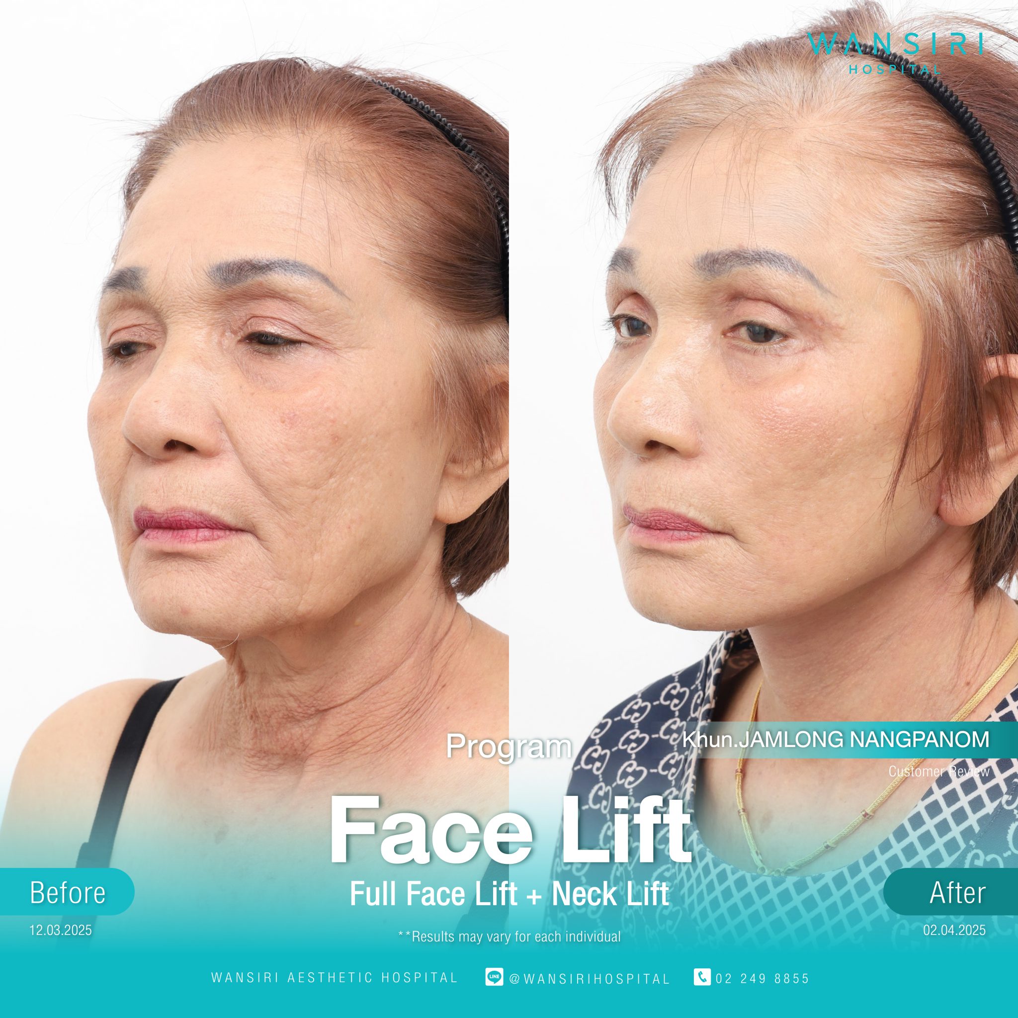 Face Lift - Wansiri Hospital
